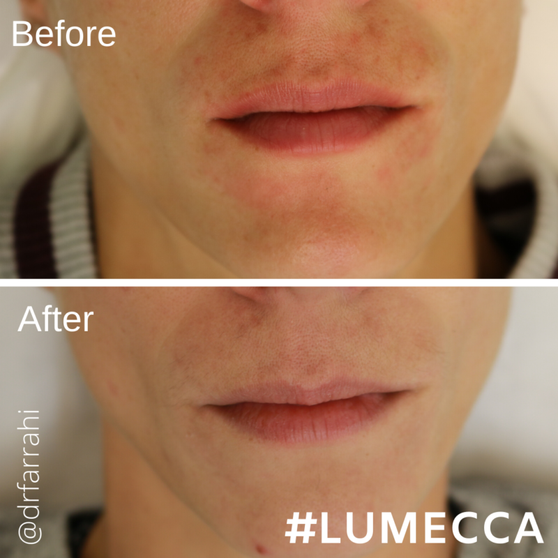 Laser Dark Spots | LiLyDermis | Calgary | Alberta | Canada