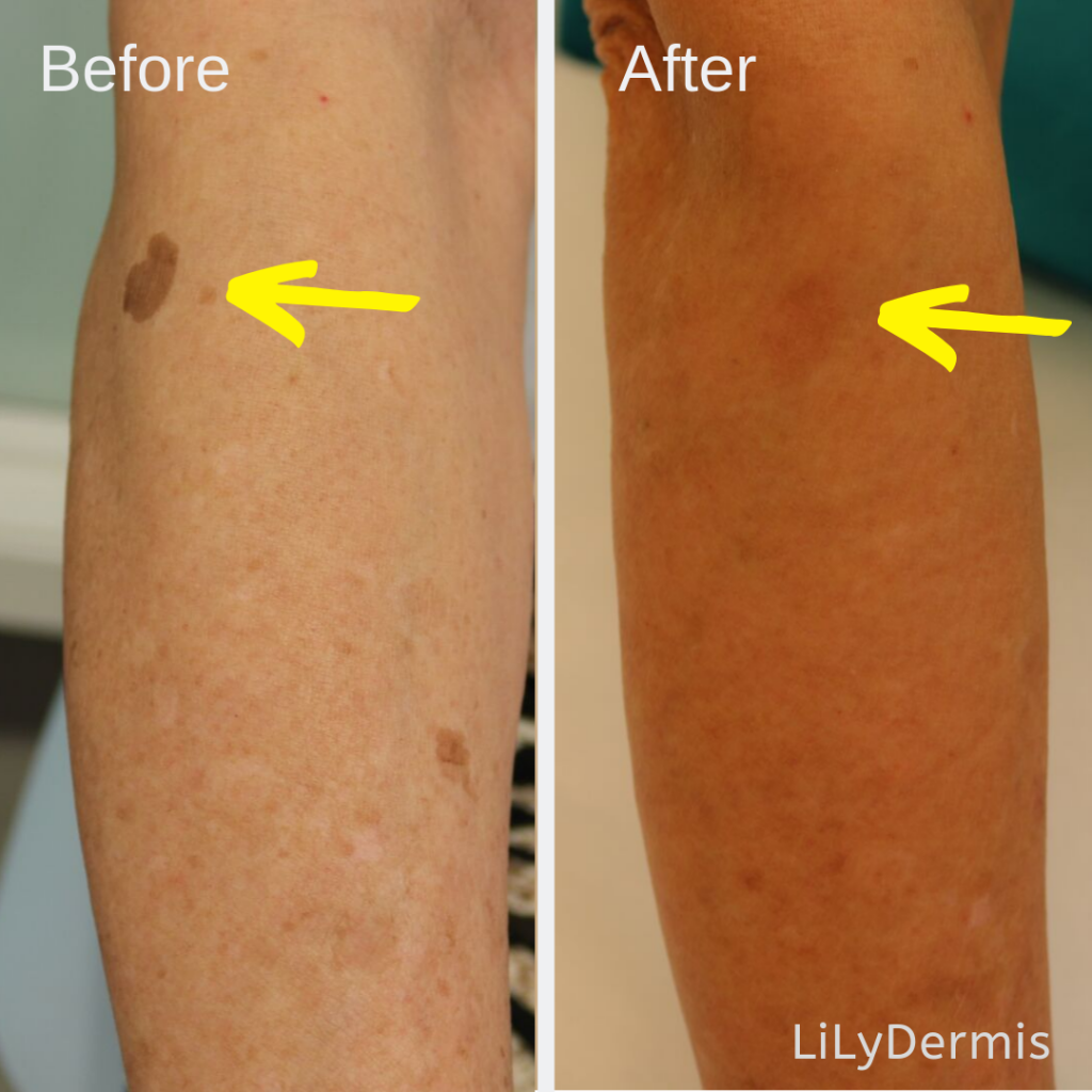 Laser Dark Spots | LiLyDermis | Calgary | Alberta | Canada