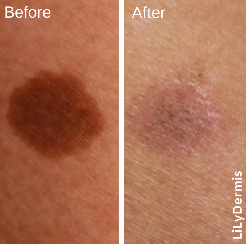 Laser Dark Spots | LiLyDermis | Calgary | Alberta | Canada