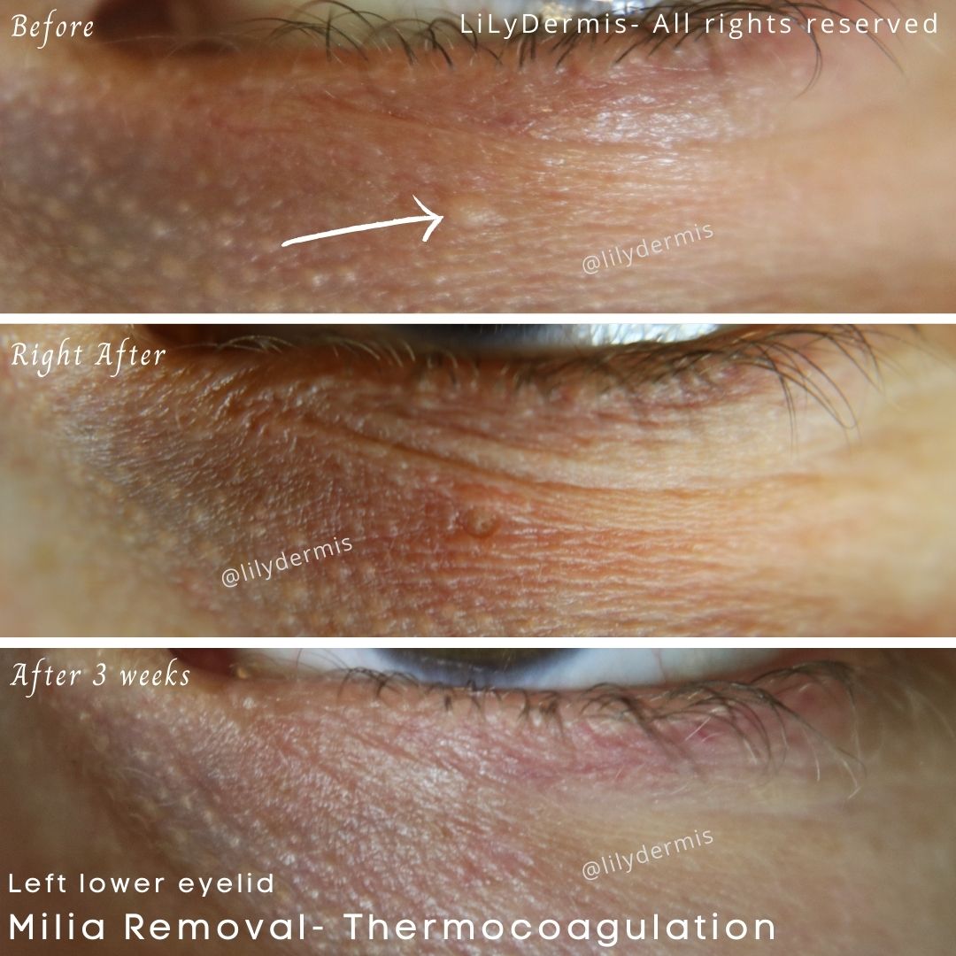 Milia Removal Before And After