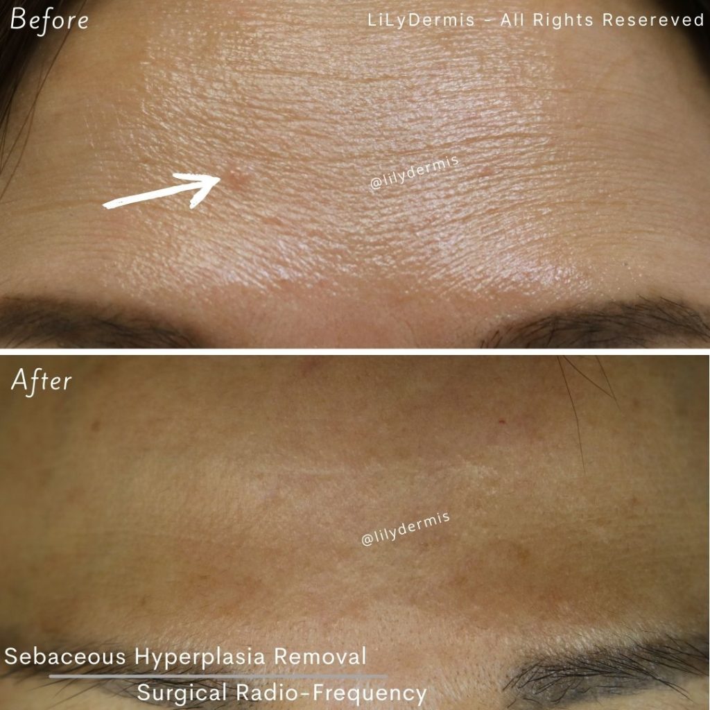 Sebaceous Hyperplasia Removal In Calgary Lilydermis