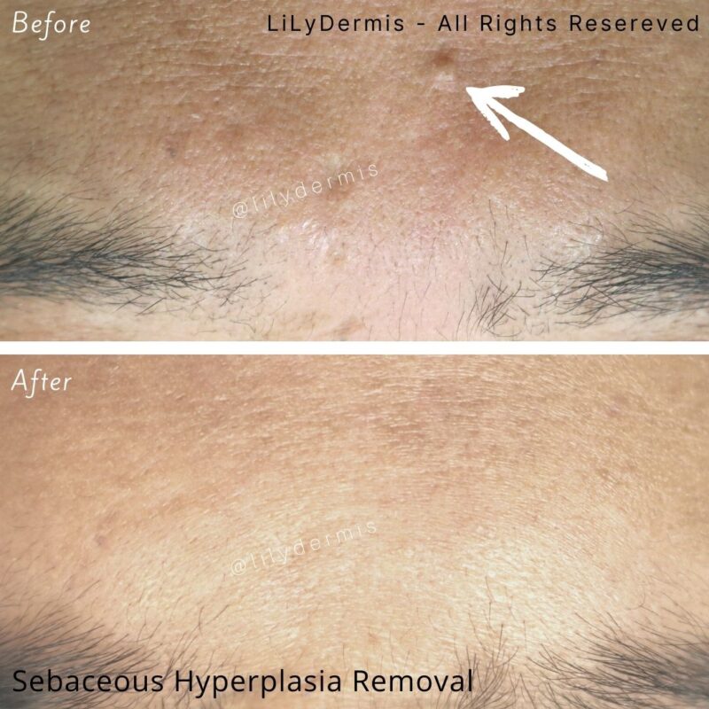 Sebaceous Hyperplasia Removal | LiLyDermis | Calgary