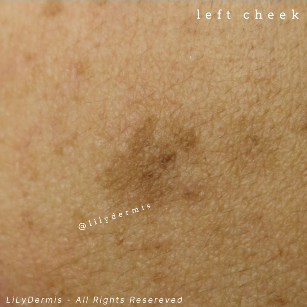 Solar Lentigo Sun Spot Removal | LiLyDermis | Calgary