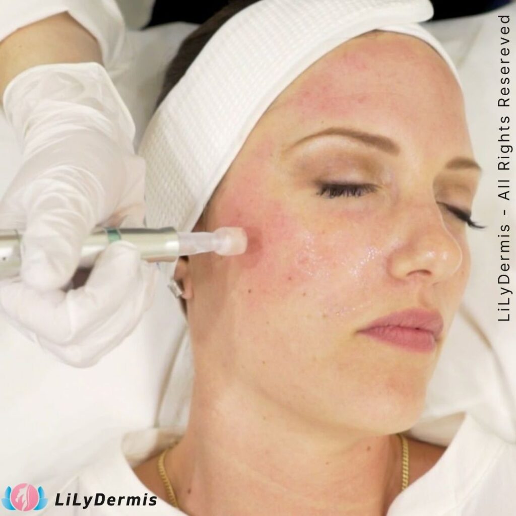 Microneedling | LiLyDermis | Calgary