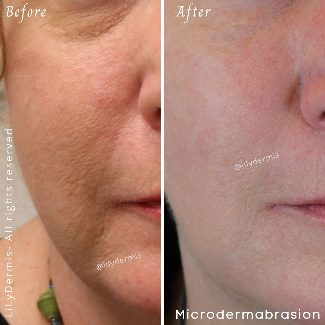 Microdermabrasion In Calgary Smooth Radiant Skin At LiLyDermis