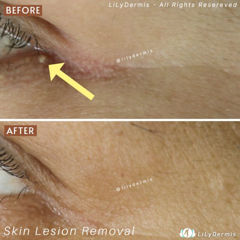 Milia Removal in Calgary | Safe & Professional at LiLyDermis