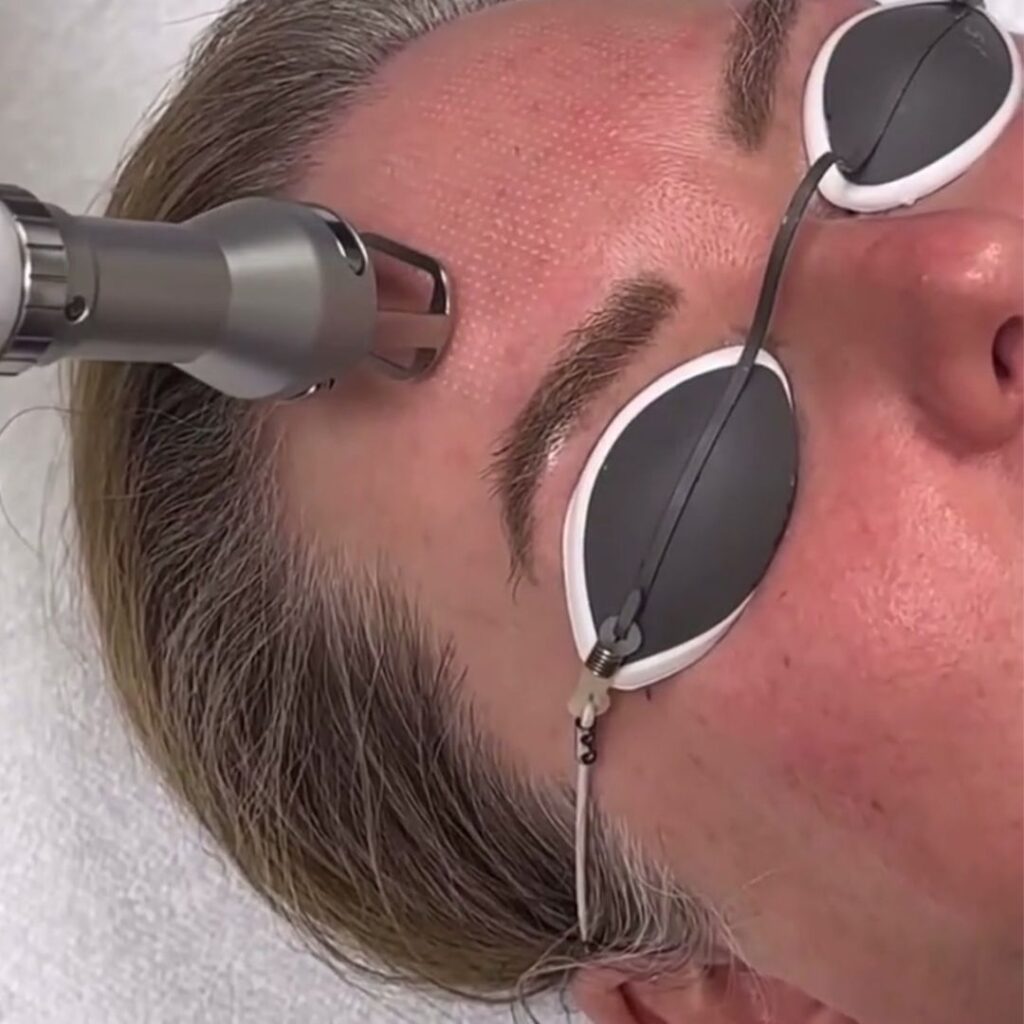 Erbium YAG fractional laser resurfacing | Calgary | LiLyDermis